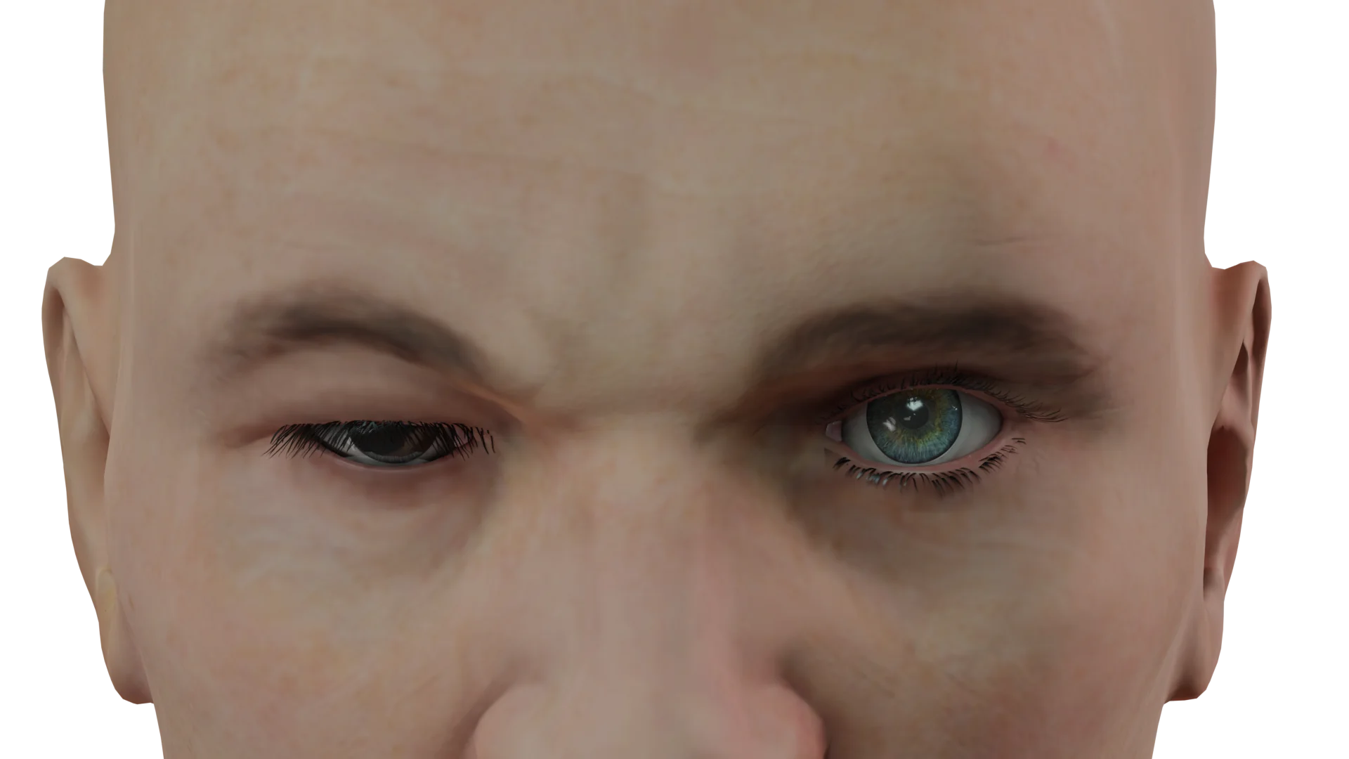 Pterygium: Definition, Causes, Severity, Diagnosis, Treatment